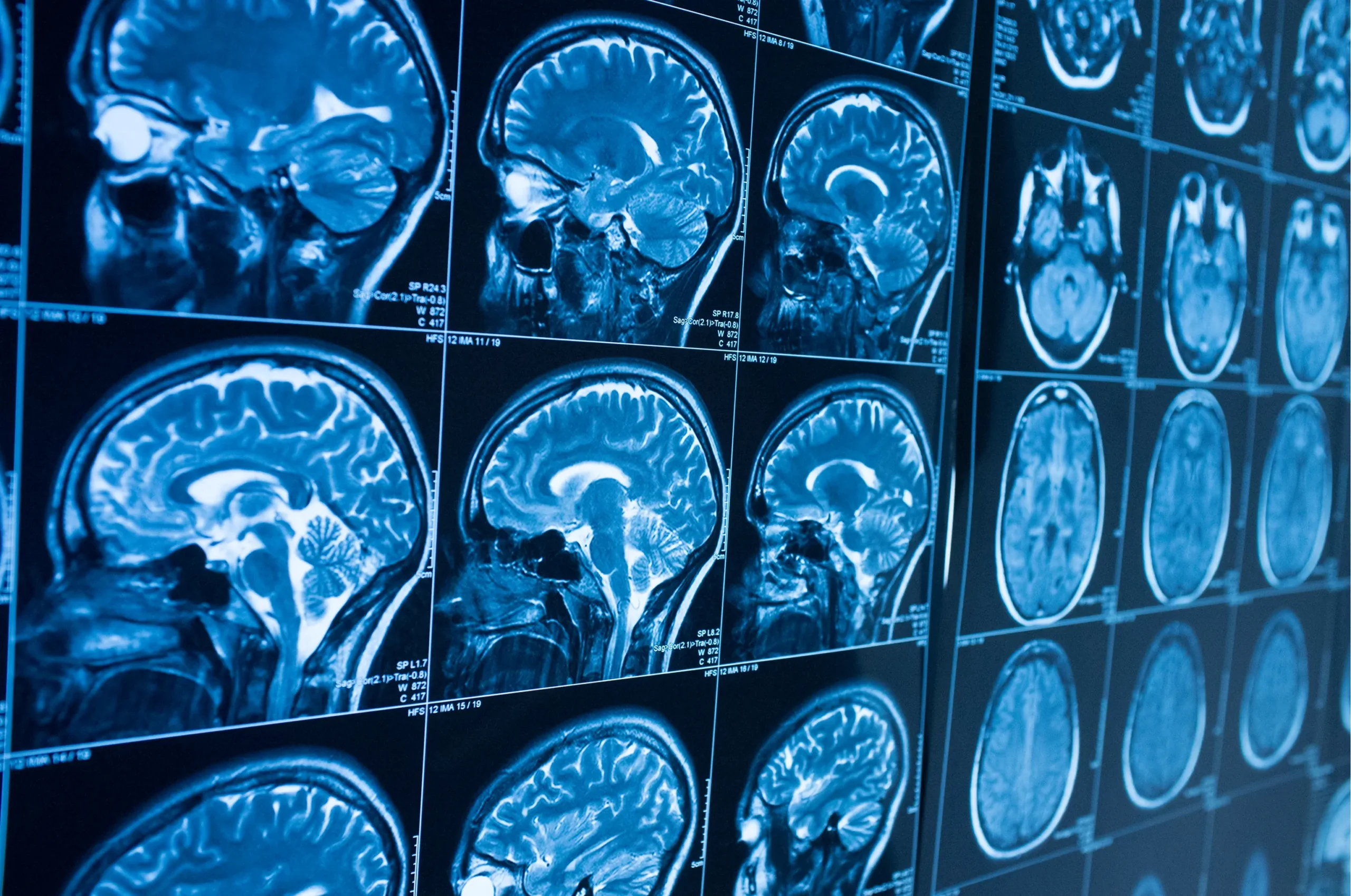 We Help TBI Victims Get Compensation - Skolrood Law